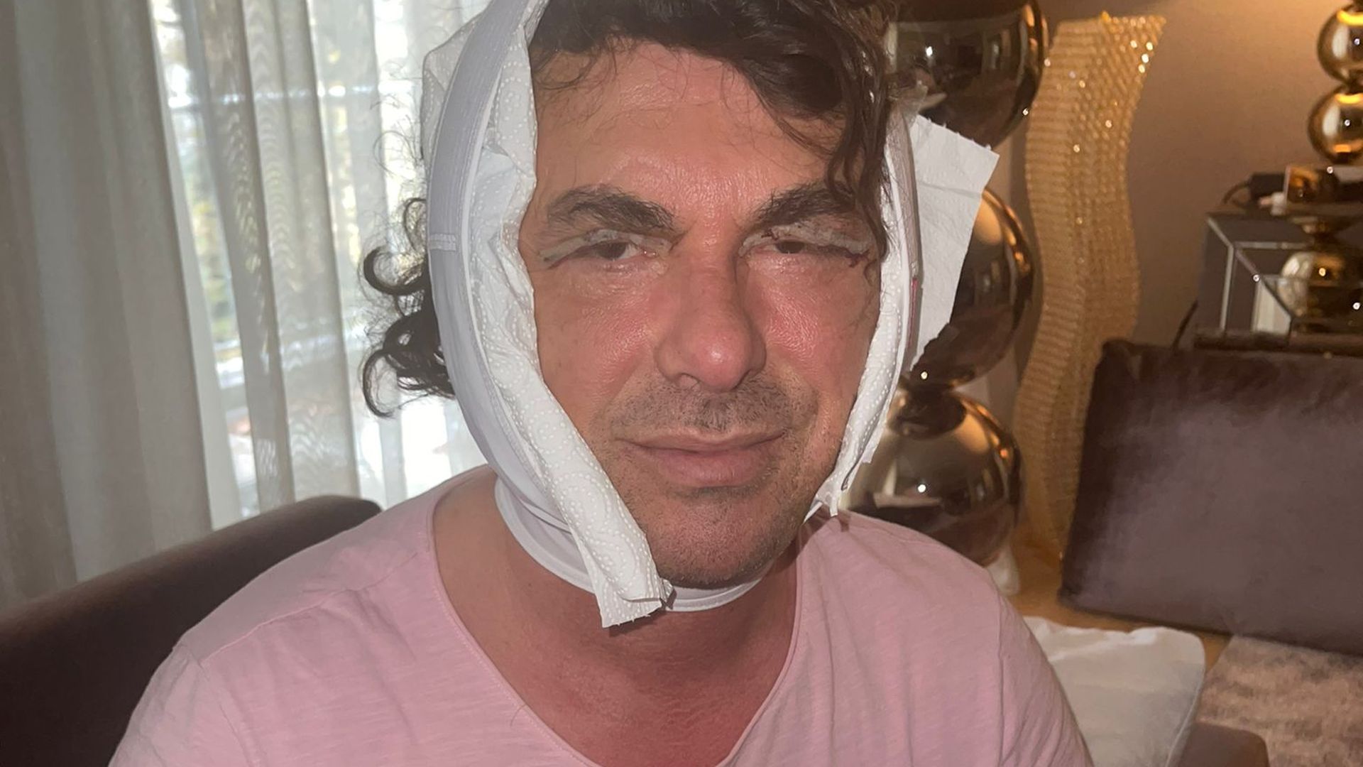 Ismet Atli happy nach Facelift: Er braucht keine Filter mehr