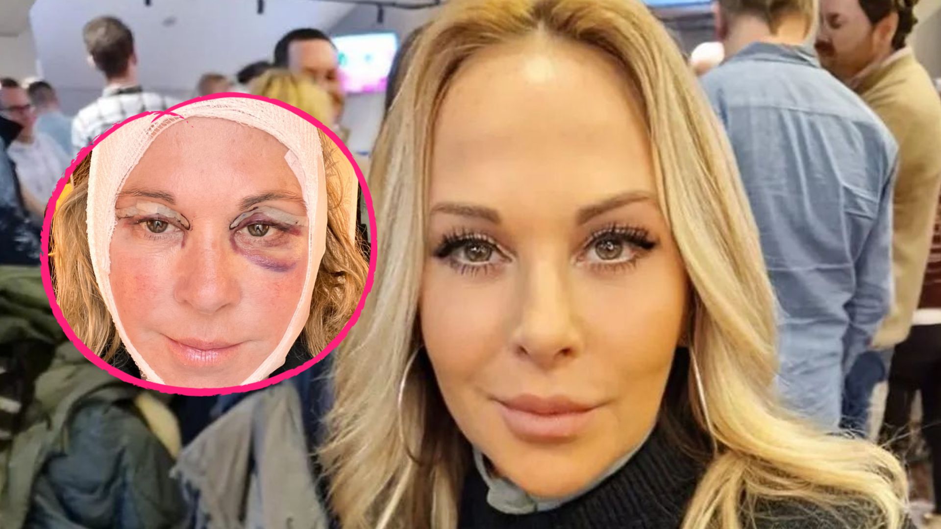 Für Malle: Sängerin Krümel hat sich Gesicht operieren lassen